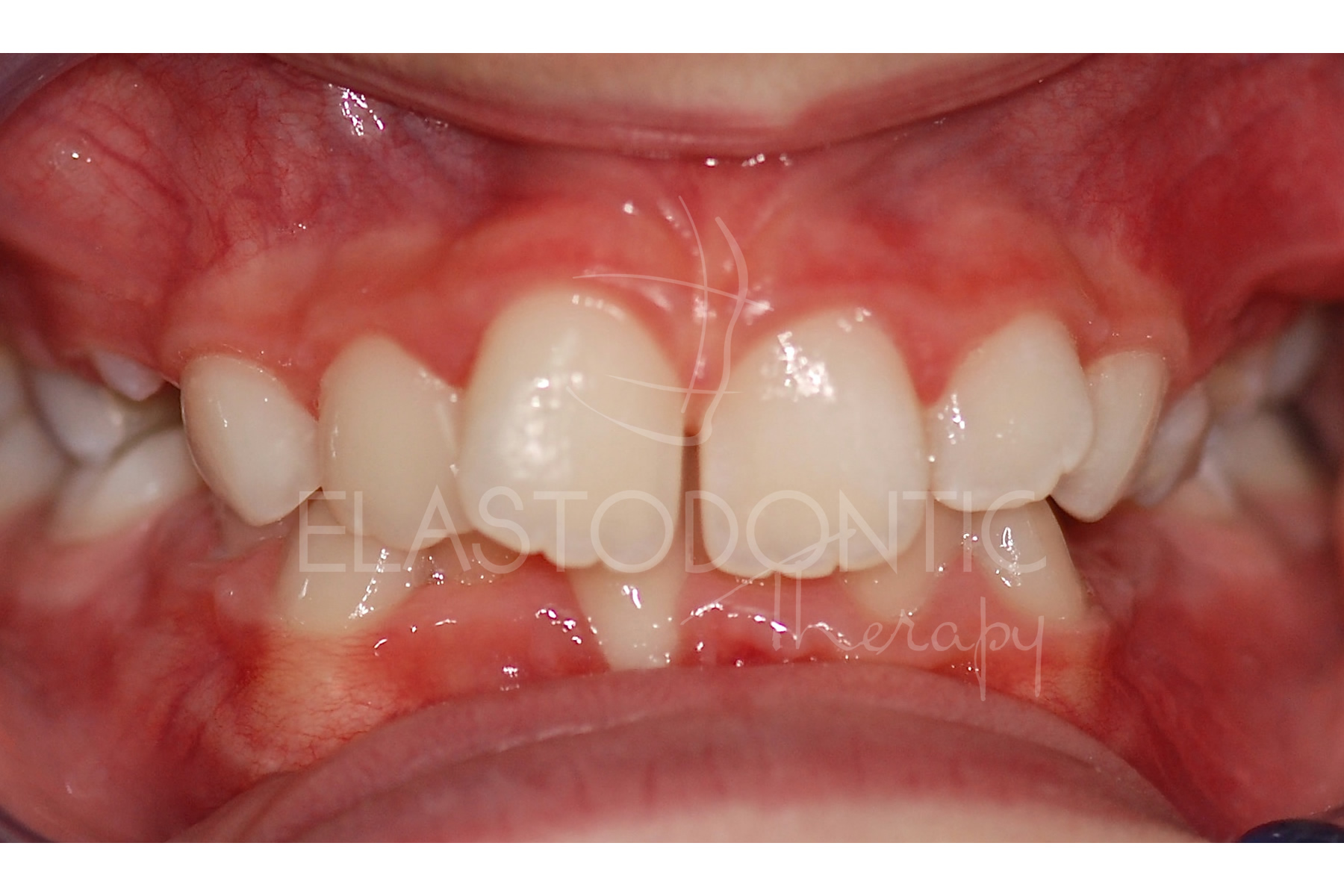 Denti Affollati - Elastodontic Therapy