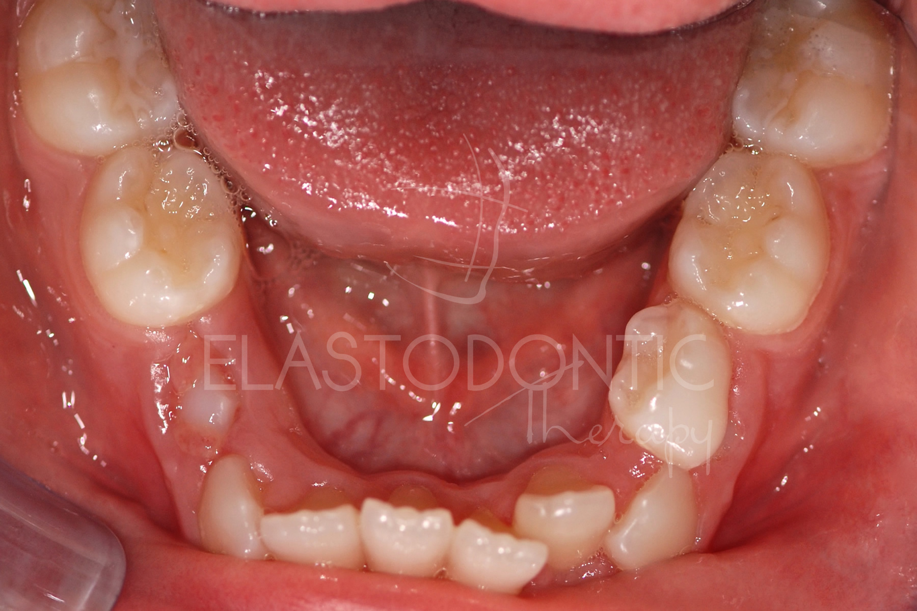 Denti Affollati - Elastodontic Therapy