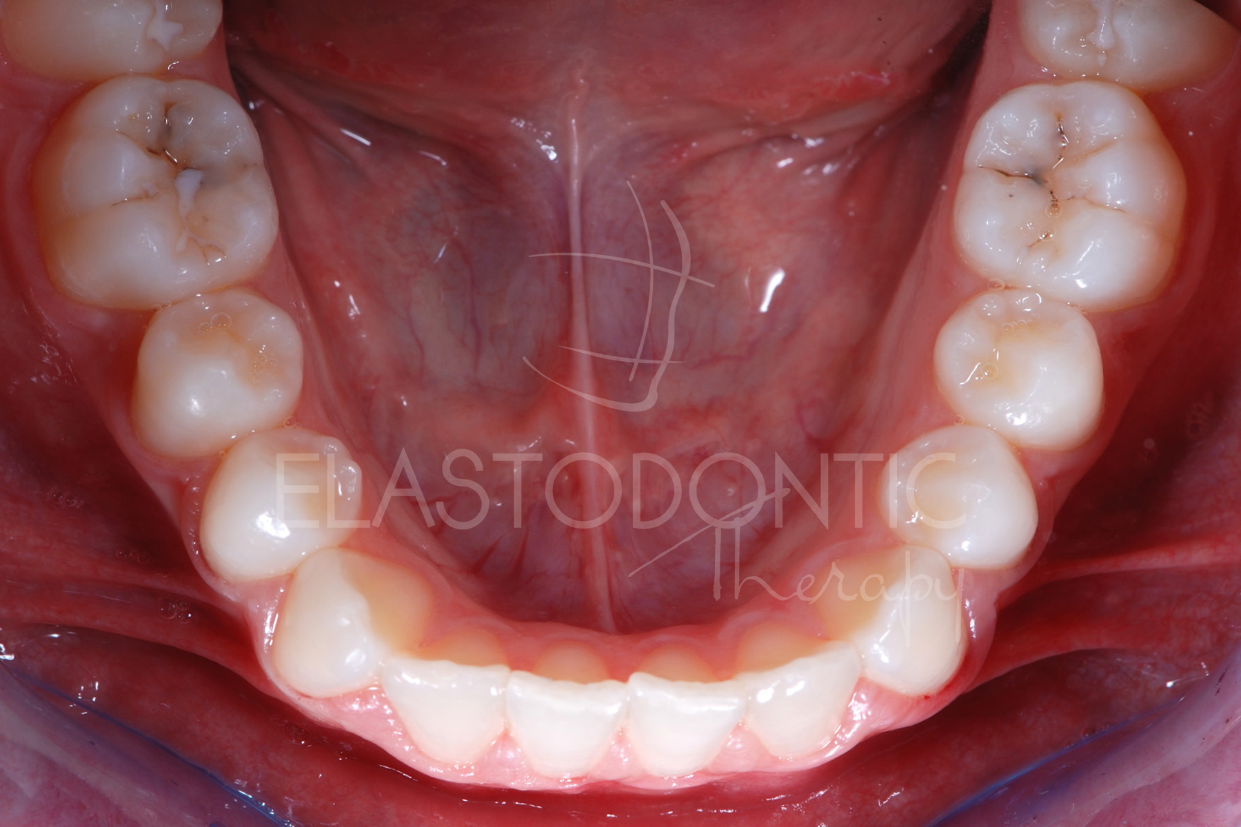 Denti Affollati - Elastodontic Therapy