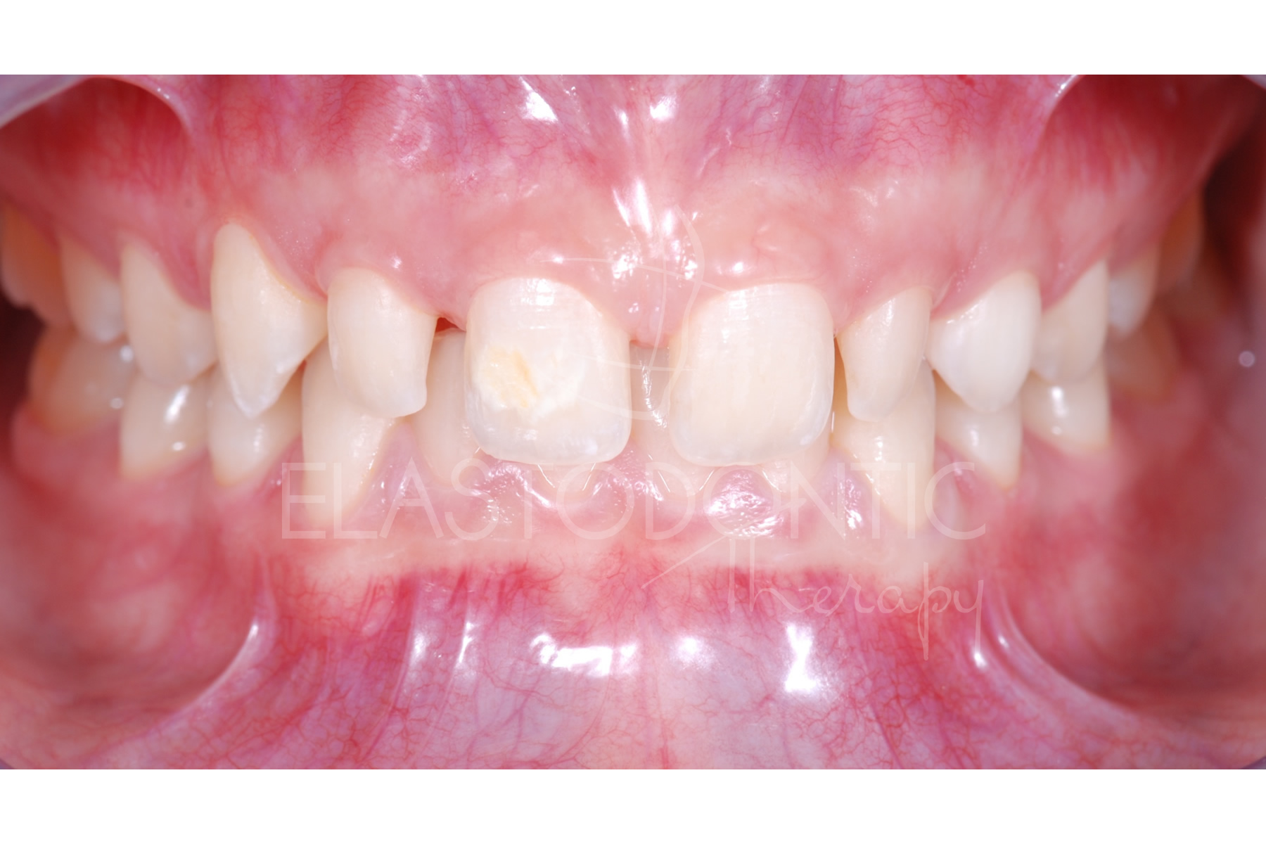 Estetico - Elastodontic Therapy