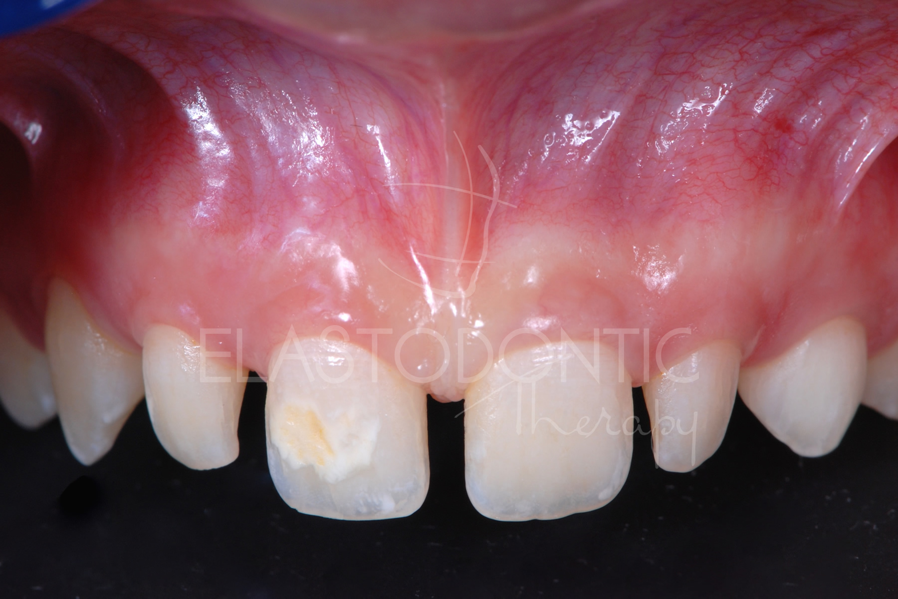 Estetico - Elastodontic Therapy