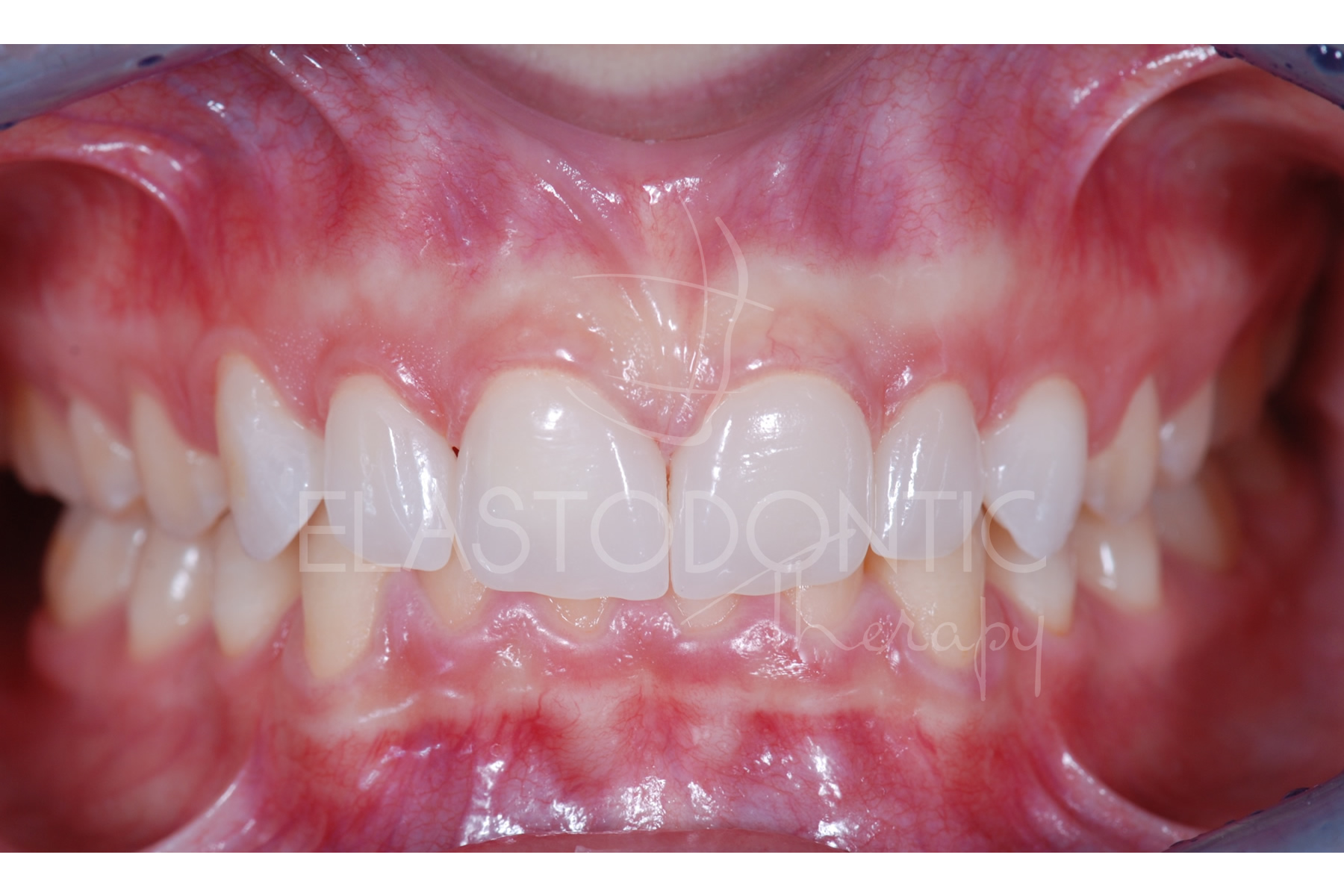 Estetico - Elastodontic Therapy
