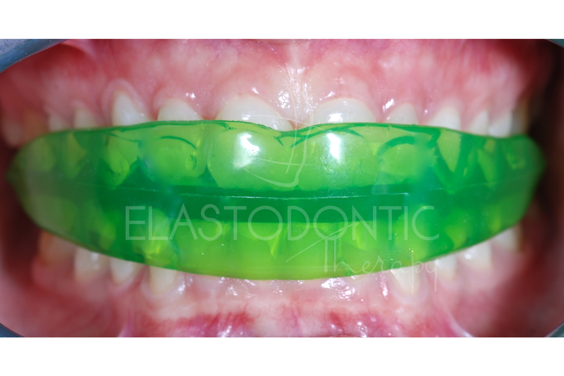 Estetico - Elastodontic Therapy