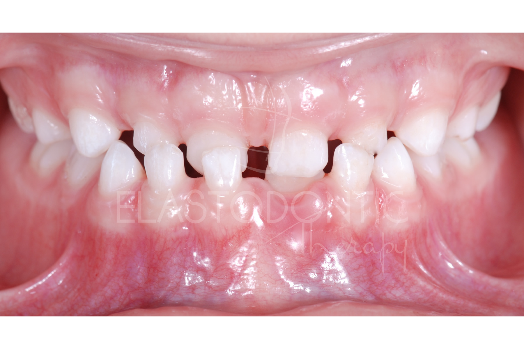 III Classe - Elastodontic Therapy