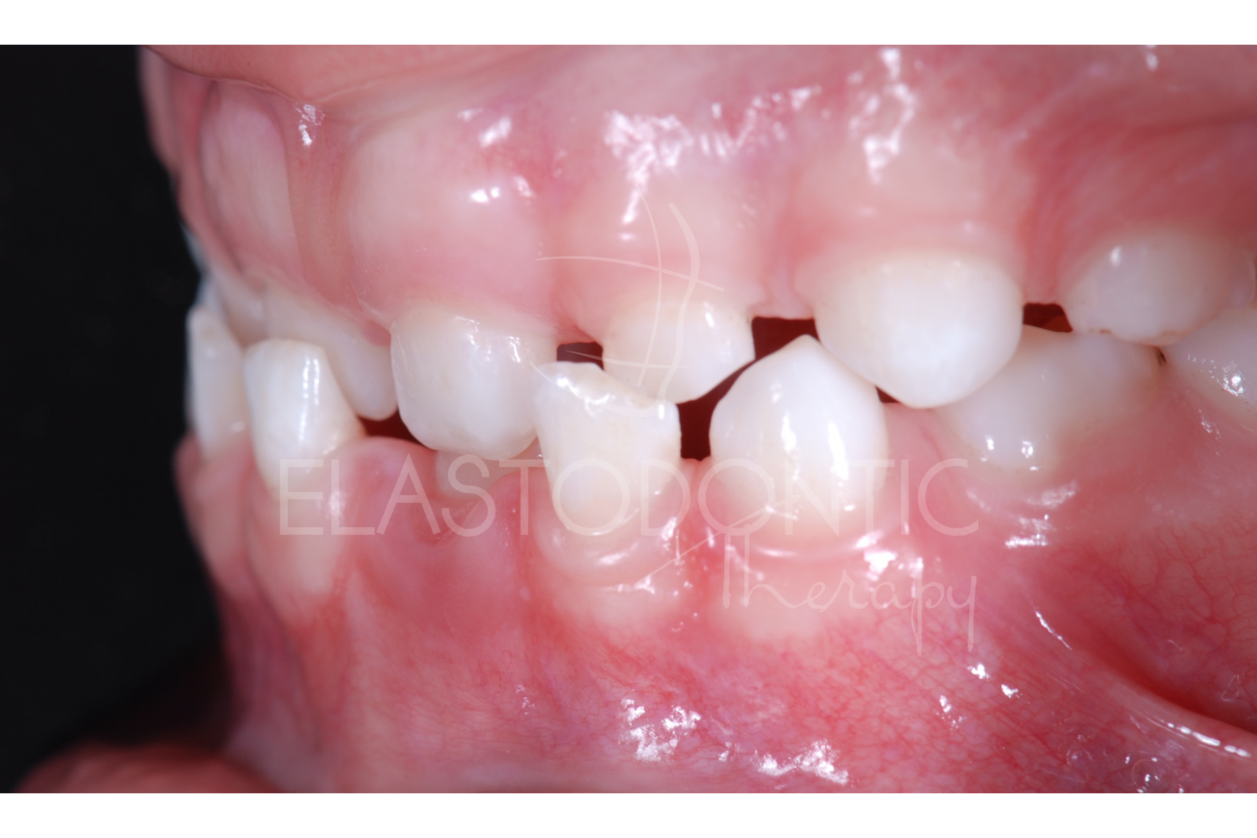 III Classe - Elastodontic Therapy