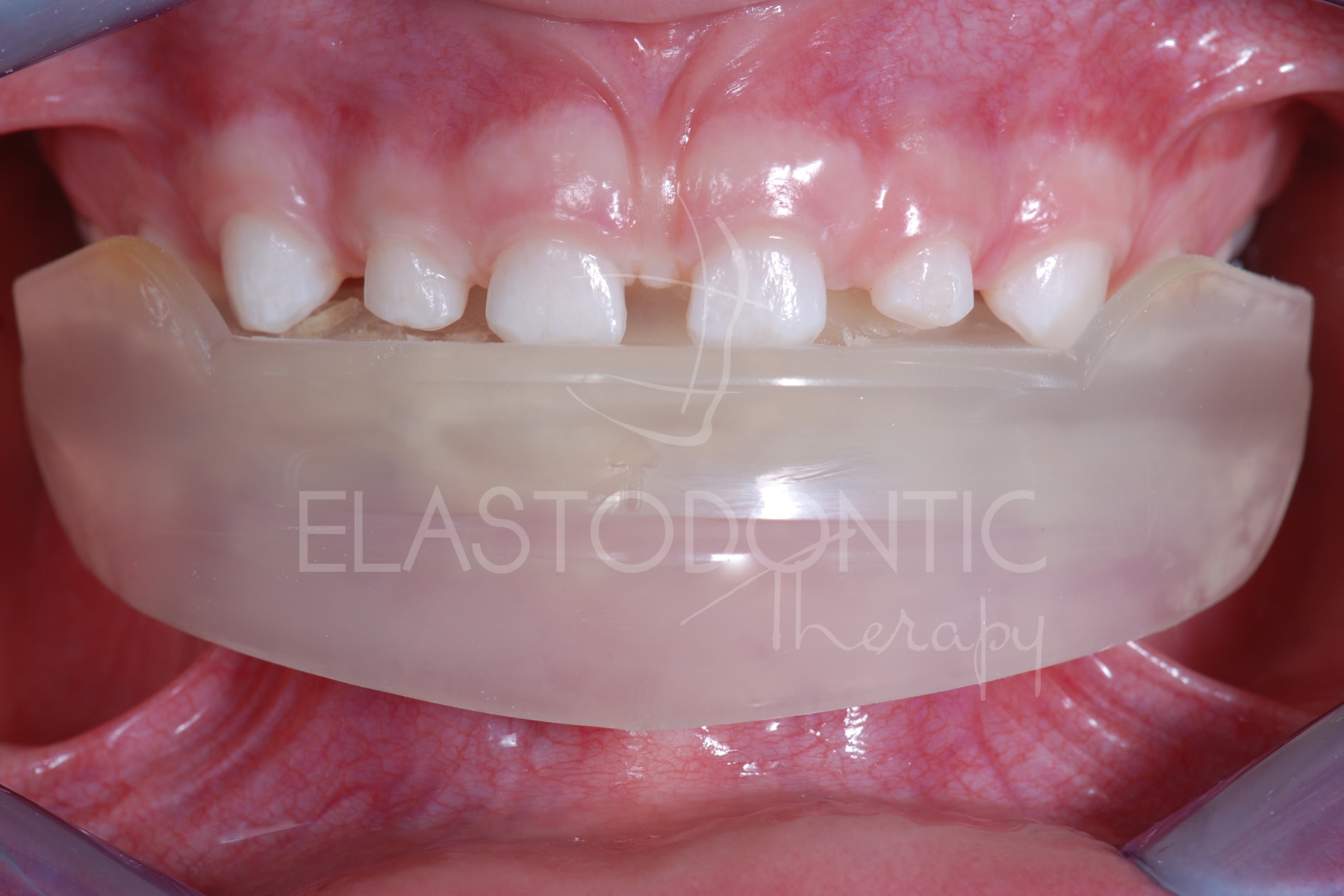 III Classe - Elastodontic Therapy