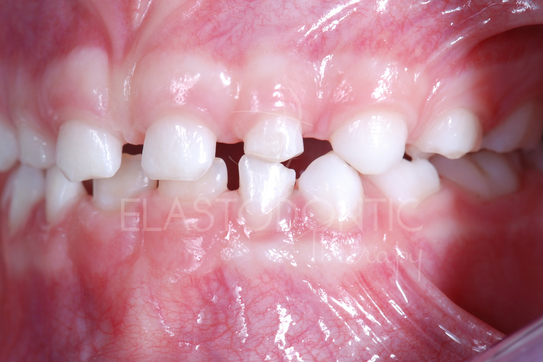 III Classe - Elastodontic Therapy