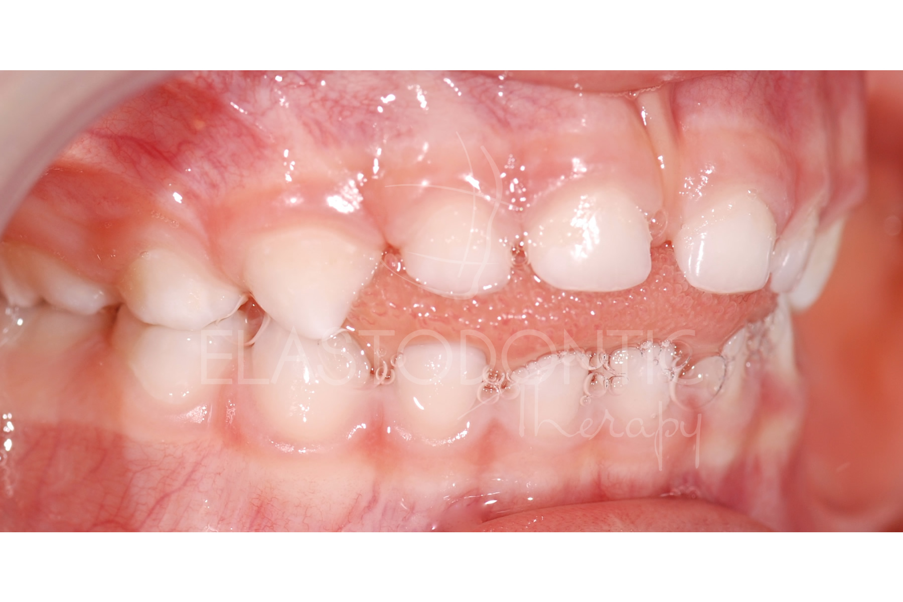Morso Aperto Anteriore - Elastodontic Therapy