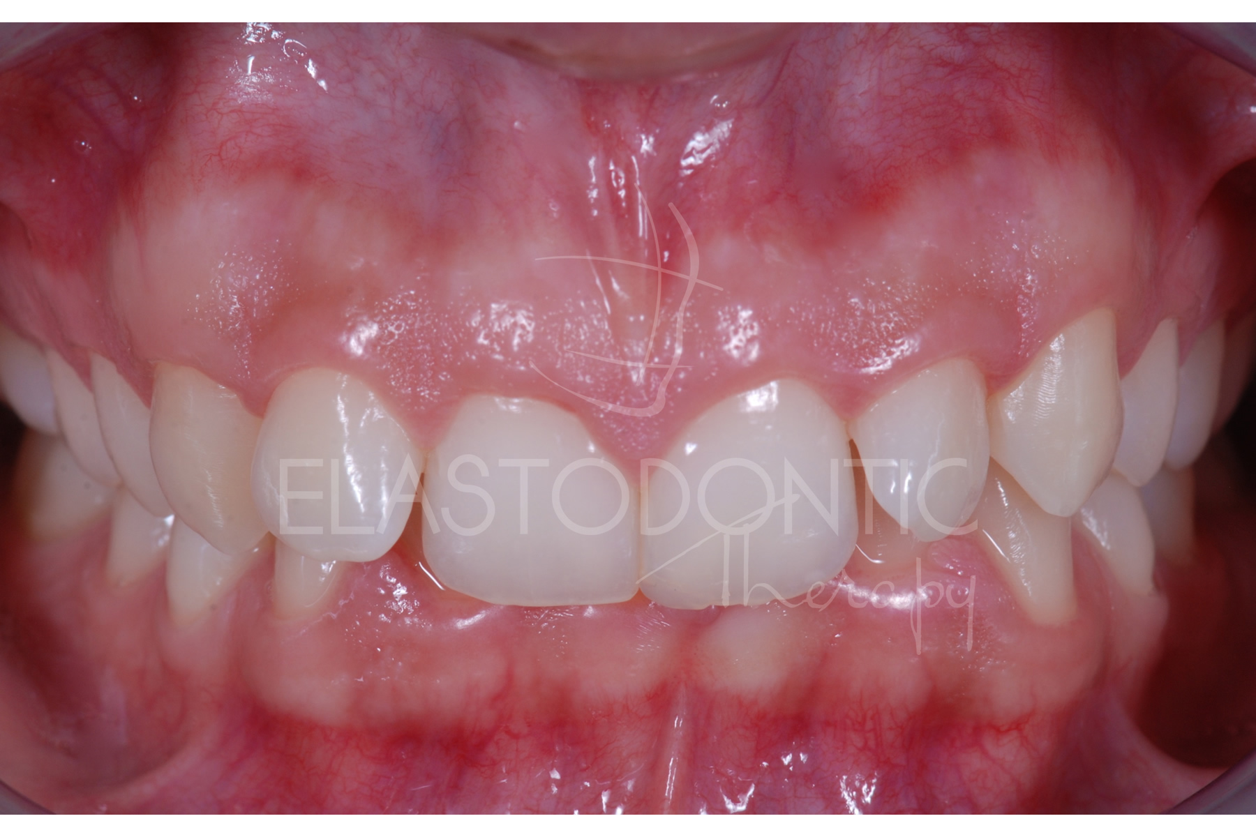 Morso Profondo Adulto - Elastodontic Therapy
